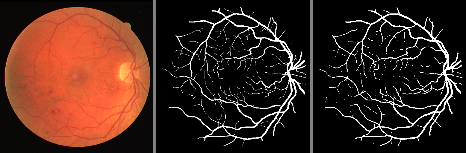GitHub - vartikatrao/RetinalVeselSegmentation: Retinal Vessel ...