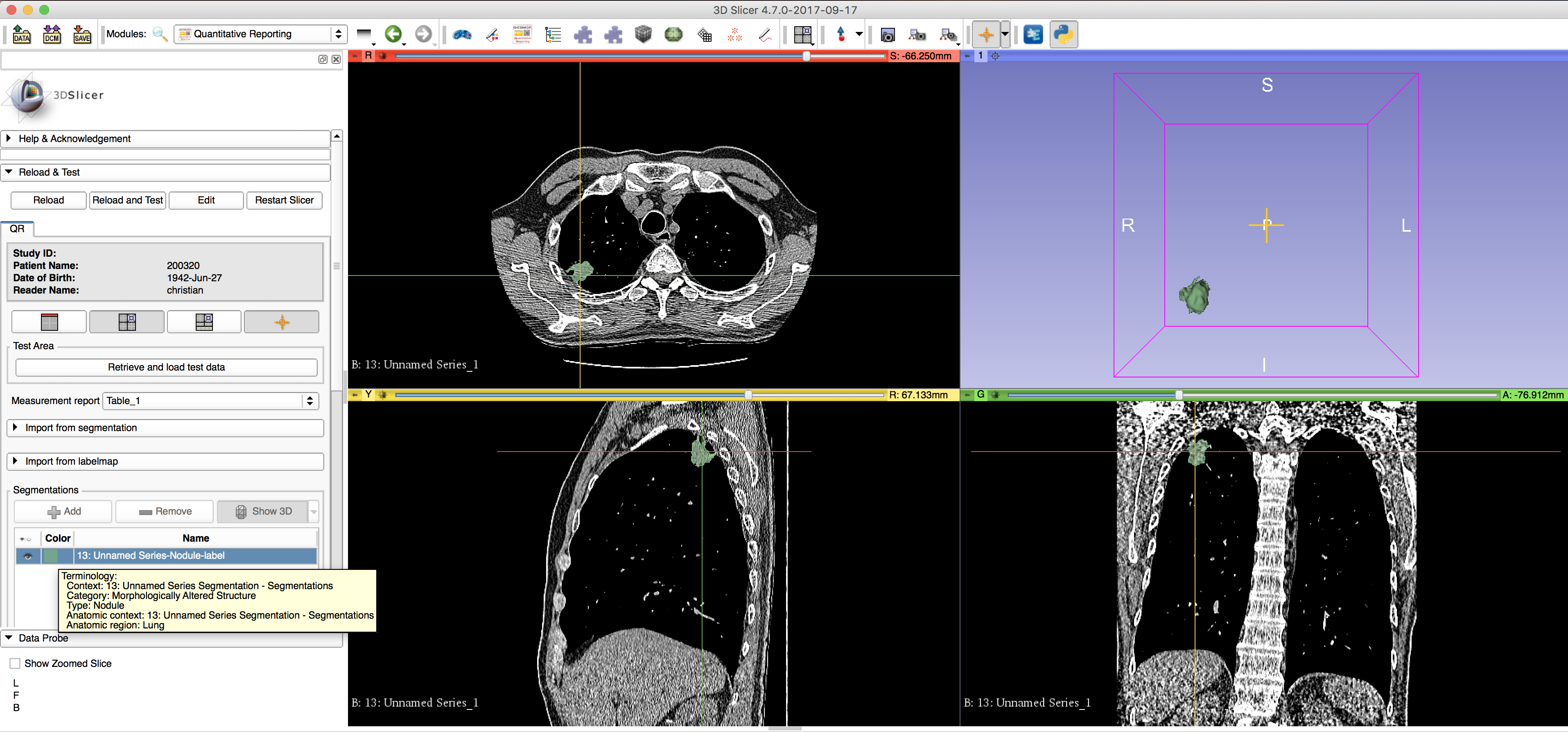 Anatomic Region Modifier is not displayed in terminology tooltip ...