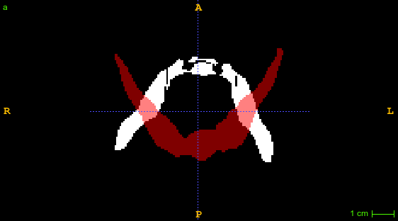 fix: Evaluation on CTPelvic1k-Abdomen, Cervix · Issue #4 · naamiinepal/xrayto3D-benchmark · GitHub