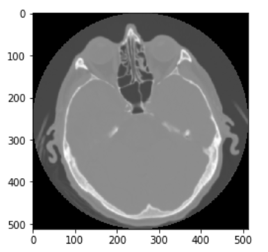 'DataElement' object has no attribute 'RescaleIntercept' and 'RescaleSlope' · Issue #1749 ...