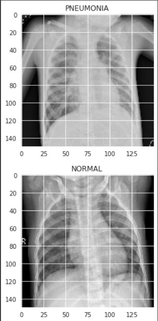 GitHub - rsnehal0102/Pneumonia_Classification_chestxray