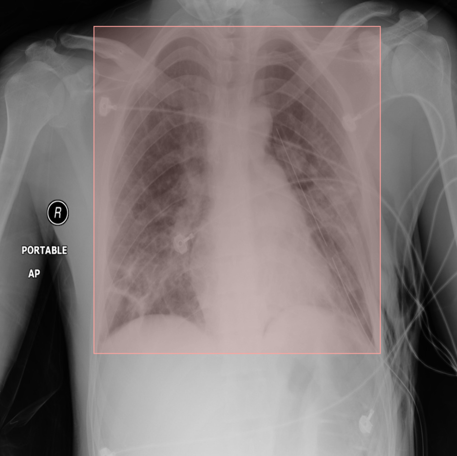 GitHub - JiseokSeo/yolov5-lung-detection