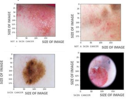 GitHub - aishu-567/Detection-of-Melonoma-skin-cancer-using-Deep ...