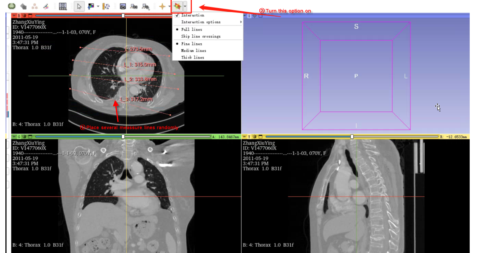 Crash in slice view showing markups and interactive slice intersections · Issue #6400 · Slicer ...