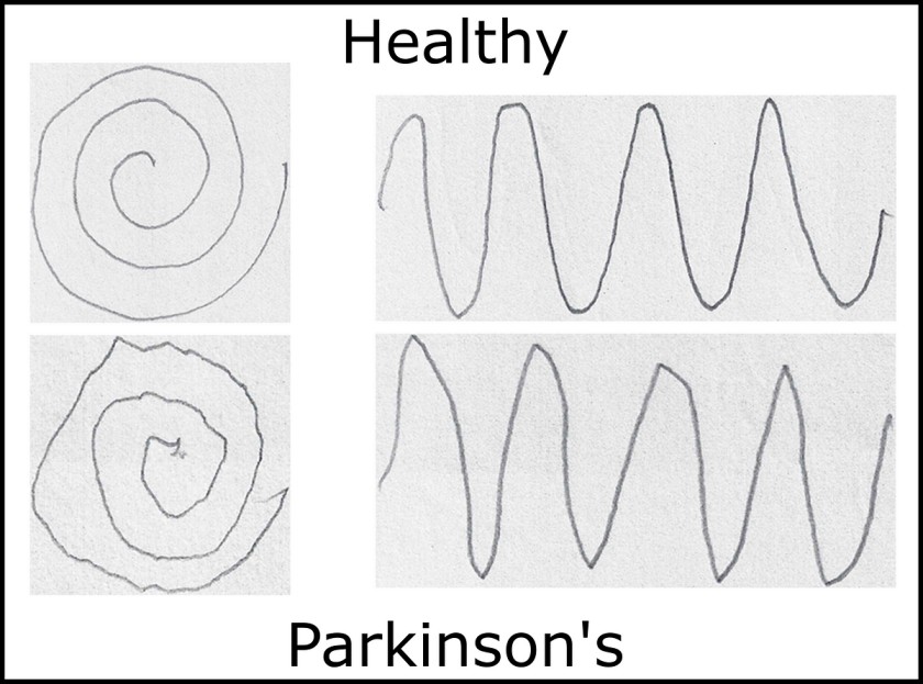 GitHub - Thanush-Prabhu/Parkinson-Disease-Prediction-using-Resnet-34