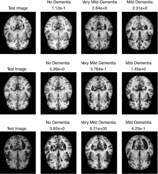 GitHub - NguyoJer/Alzheimer-s-Disease-Detection