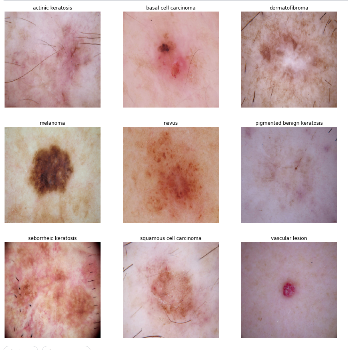 GitHub - pradeeproy303/Melanoma-Detection