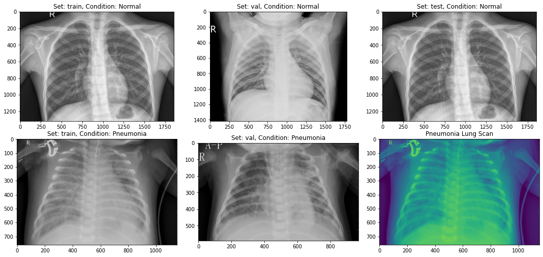 GitHub - ds-amrit/PneumoniaPrediction: In this POC computer vision and ...