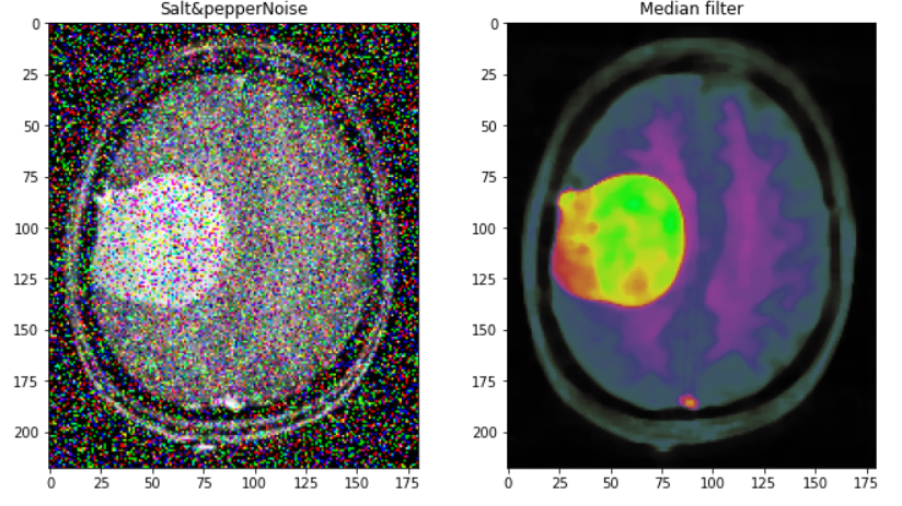 Github Ramyapravallika18 Brain Tumor Analysis