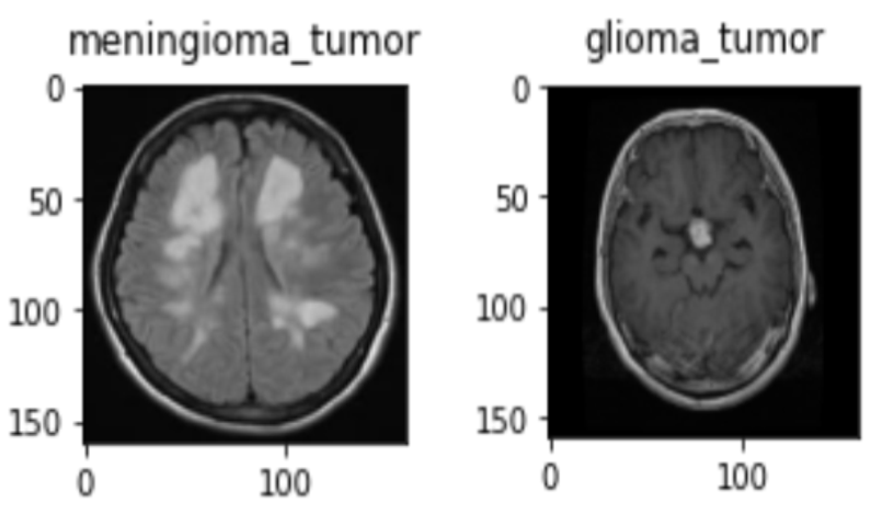 GitHub - Ramya-Pravallika/Brain-tumor-analysis