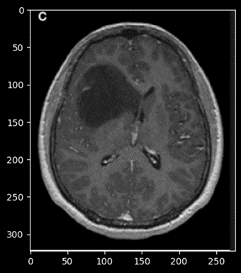 GitHub - Maheshbabukona/Brain_tumor_detection