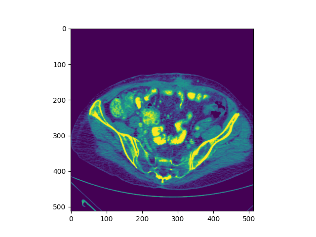 Tensorboard ，the Image Cannot Be Displayed Correctly · Issue 55 · Hucaofightingswin Unet · Github