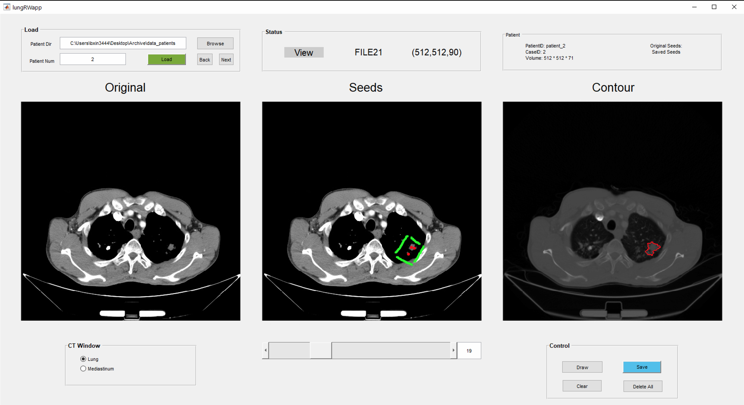GitHub - bxin3444/lung_seg_interactive: Interactive segmentation software for lung tumours ...