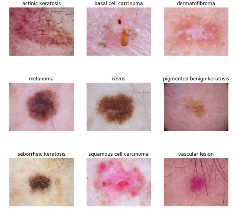 GitHub - SurobhiD/CNN-Model-Cancer-Detection: Building a CNN-based multi-class classification ...