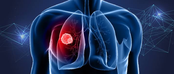 GitHub - Usangajonah/Lung-Cancer-Prediction GitHub - Usangajonah/Lung-Cancer-Prediction