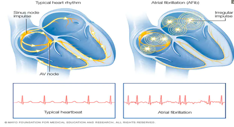 Artificial-Intelligence-Recognition-and-Interpretation-of-Atrial ...
