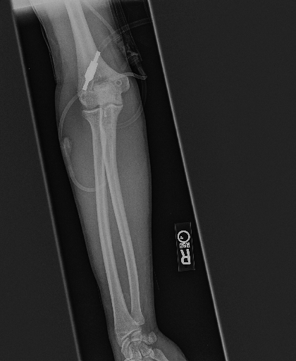 GitHub - nikhilkethu/Bone-Fracture-Recognition-using-Deep-Neural-Network