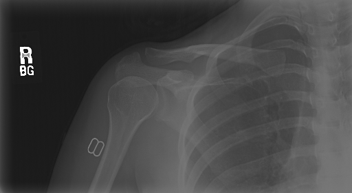 GitHub - nikhilkethu/Bone-Fracture-Recognition-using-Deep-Neural-Network