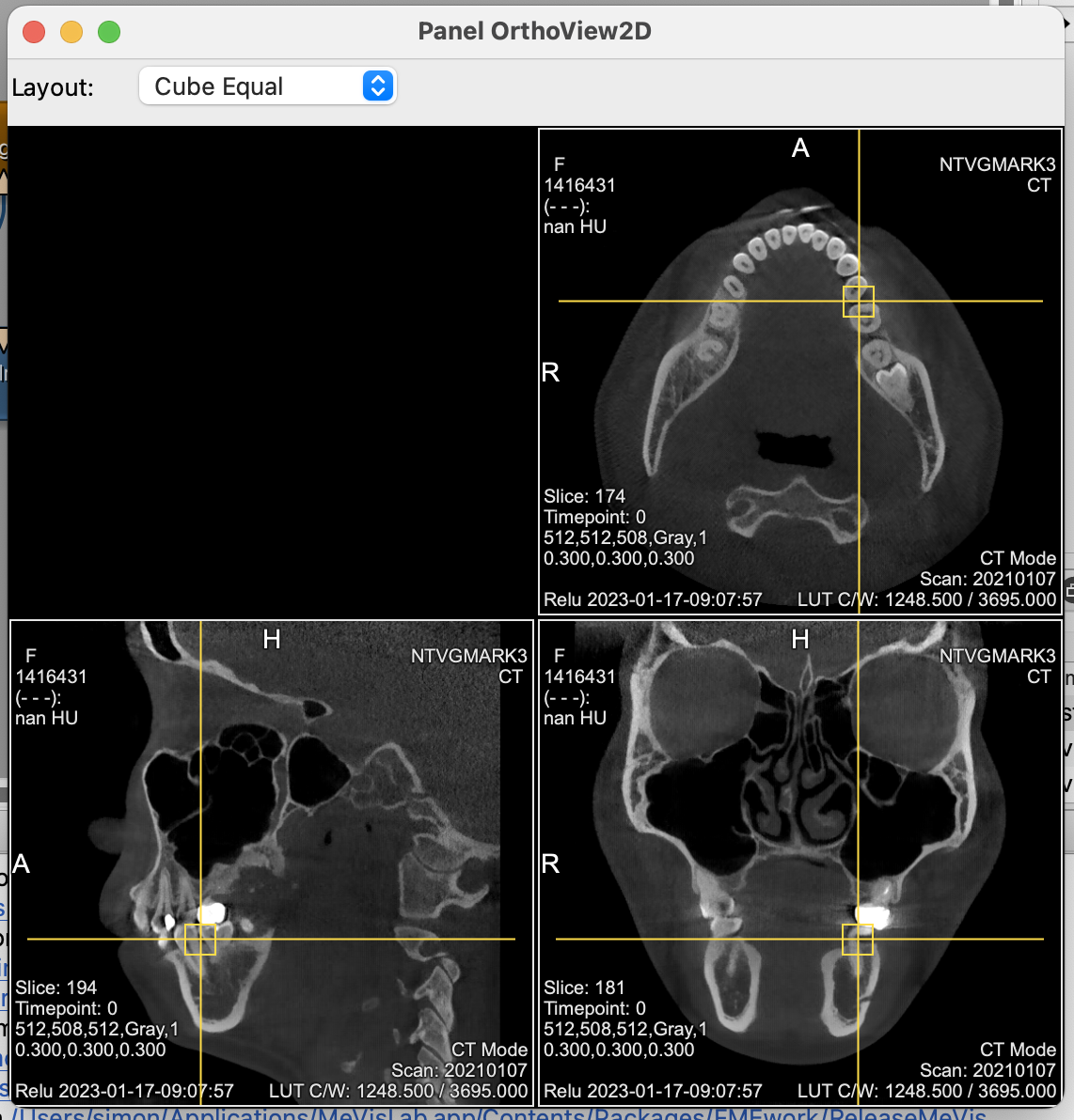 z spacing incorrectly read for multi-frame dicom · Issue #6773 · Slicer/Slicer · GitHub