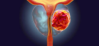 GitHub - ChineduGboof/Prostate-Cancer-Machine-Learning-Prediction