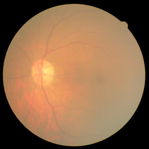 GitHub - Nithish-2002/Predection-of-ocular-disease-using-fundus-images-using-CNN: Deep learning ...
