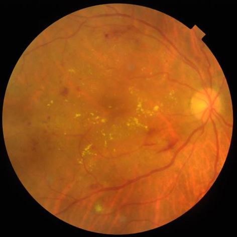 GitHub - Nithish-2002/Predection-of-ocular-disease-using-fundus-images-using-CNN: Deep learning ...