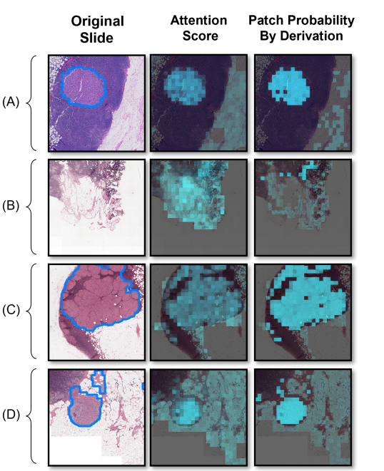 HeatMap · Issue #5 · Dootmaan/DTFD-MIL.PyTorch · GitHub