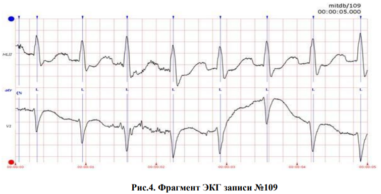 GitHub - Alexds29/ecg_classification