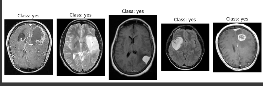 GitHub - Vinay0700/Brain_tumor_Detection