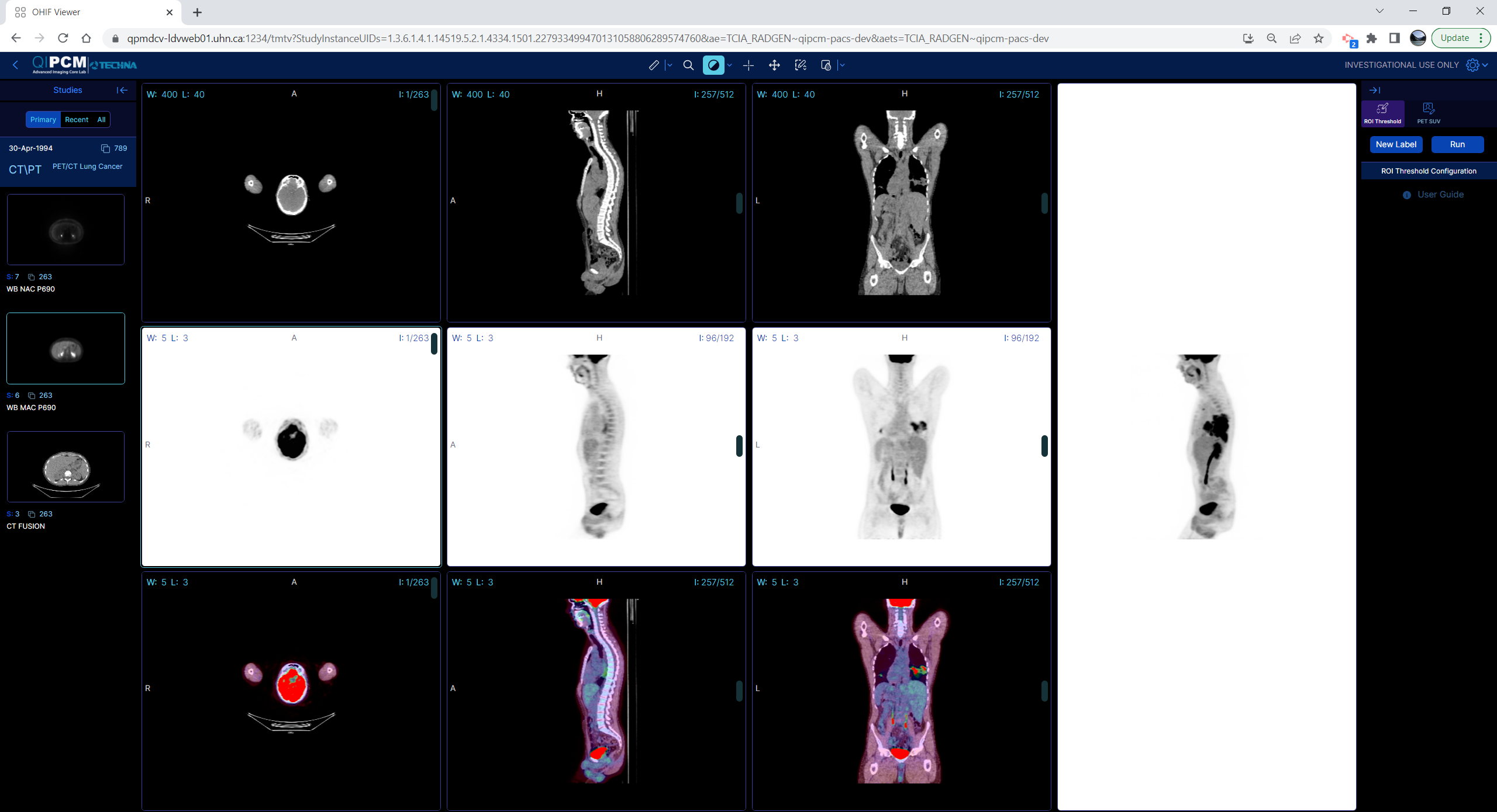 The patient ID is not visible anywhere in TMTV mode. · Issue #3065 ...