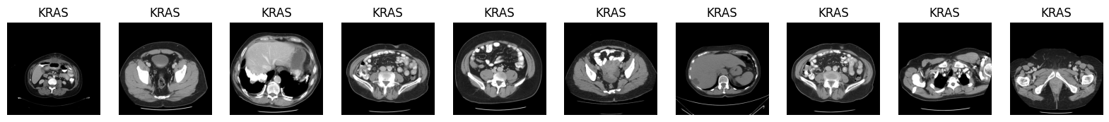GitHub - zzkeihou/Cancer-Classification-using-Convolutional-Neural-Networks