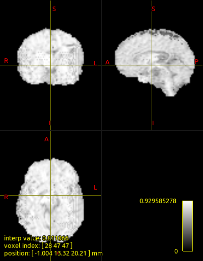 Bundle segmentation are not right for some participants while the same ...