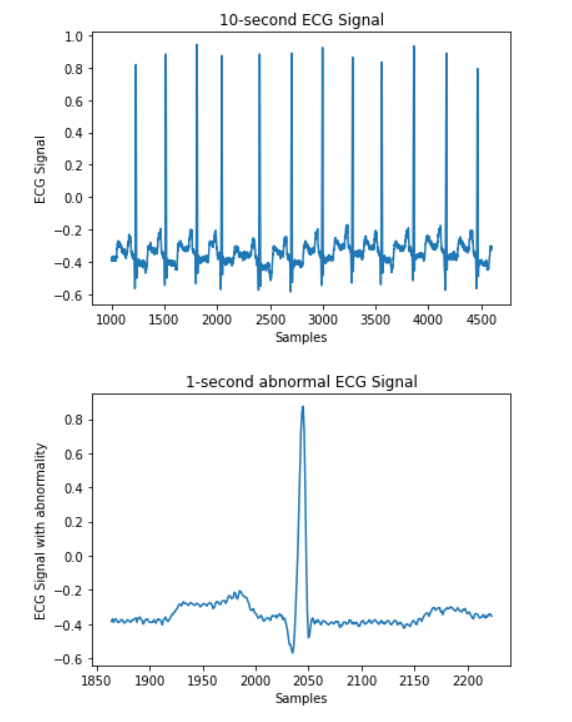 Github Krishvraman Arrhythmia Detection Lstm Cnn