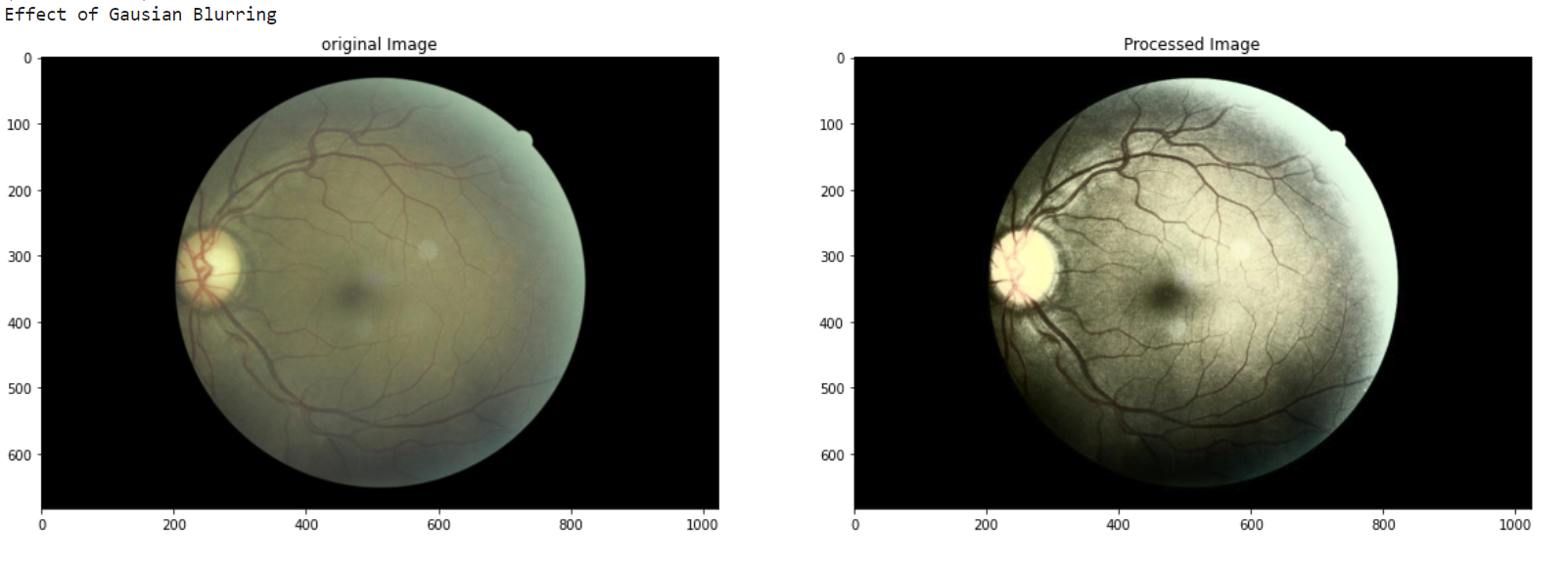 GitHub - penmetsagajendravarma/Early-Stage-Diabetic-Retinopathy-Detection