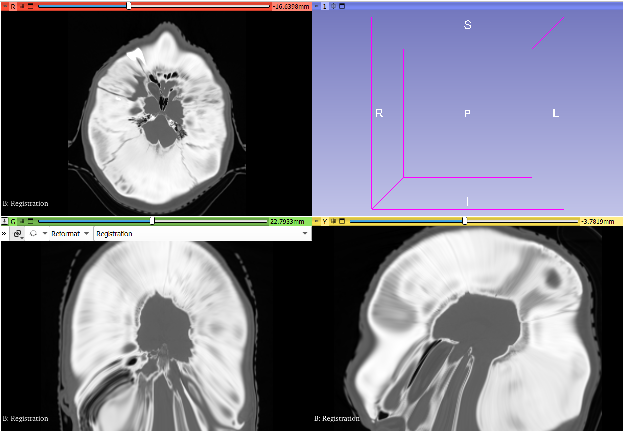 Strange output when registering brain MRI to CT scan · Issue #39 · lassoan/SlicerElastix · GitHub