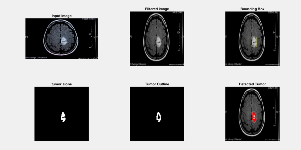 GitHub - afiqasyrf/Brain-Tumor-Detection-AIPM-GROUP-H: This repository is used for BITI3533 ...