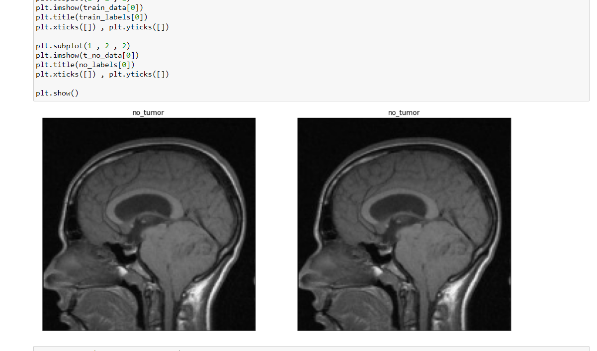 Github Omrbhdr Brain Tumor Cnn
