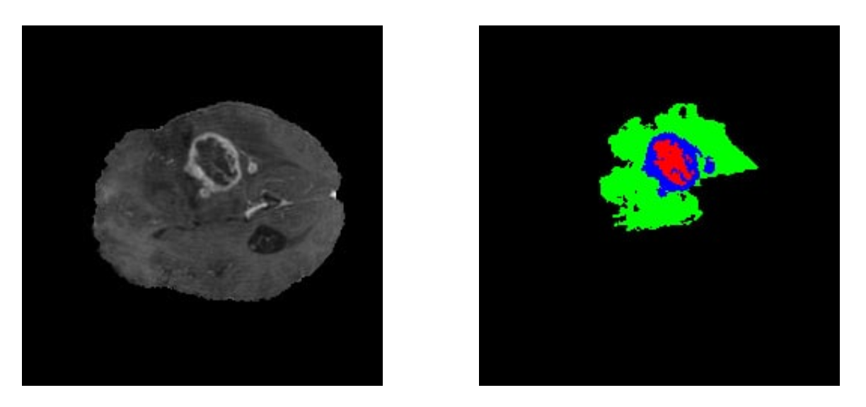 GitHub - maxkochanoff/BraTS-Challenge: Graduation project at ...