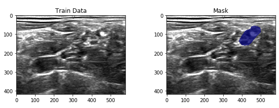 GitHub - teamsmcorg/ultrasound_nerve_segmentation