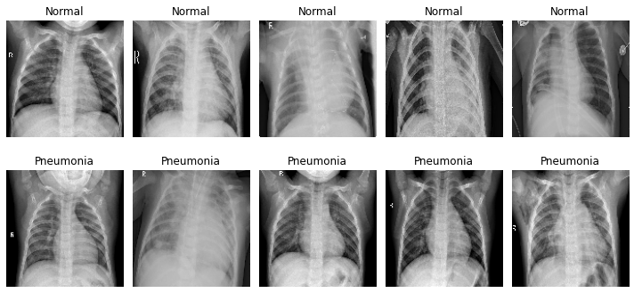 GitHub - stevegithinji/Image-Classification-Chest-X-Ray-Images-Pneumonia-