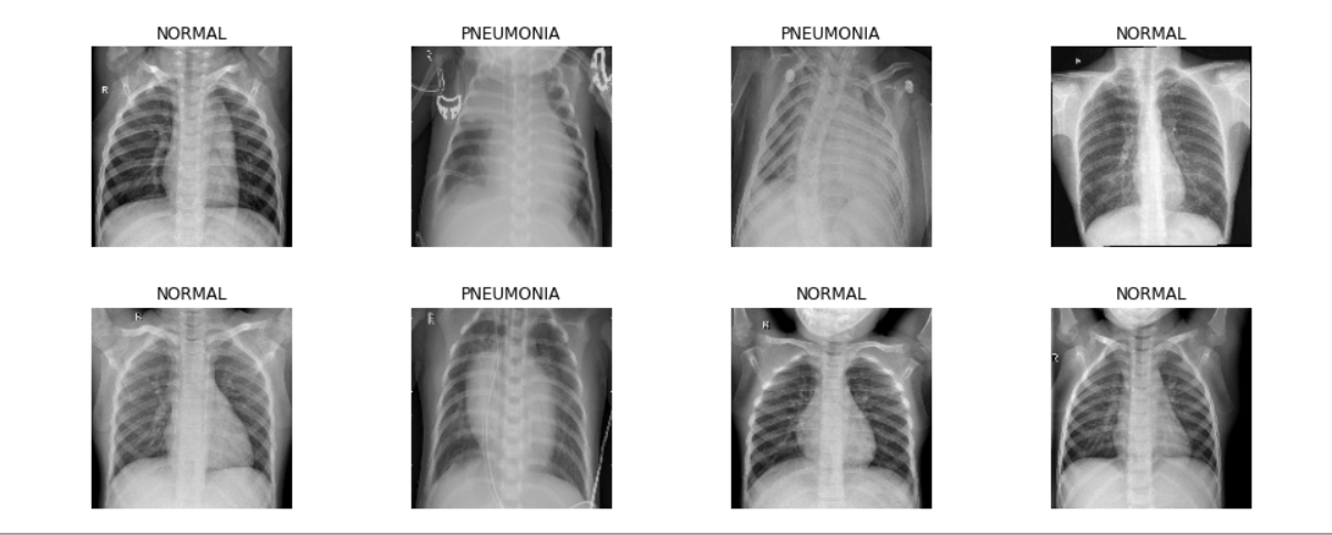 GitHub - zhvmdn/Pneumonia_Detection