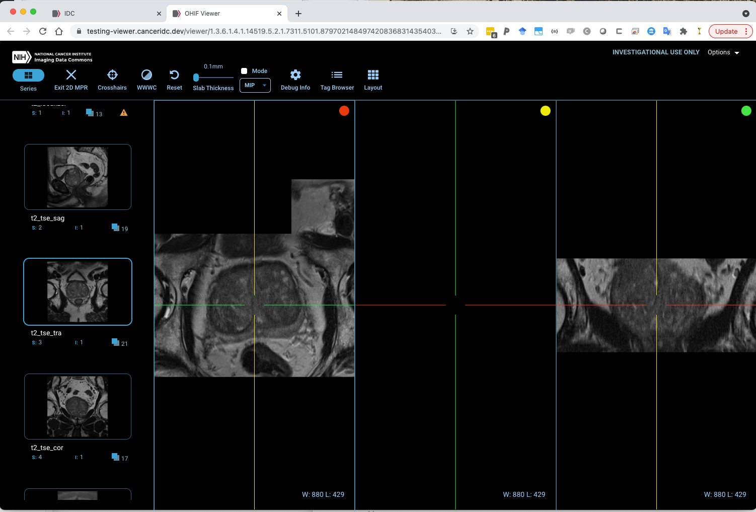 MPR render failures for some ProstateX cases · Issue #2418 · OHIF/Viewers · GitHub