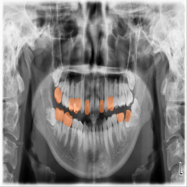 GitHub - DaliaAlzubi/yolo8-Paoramic_Segmentation
