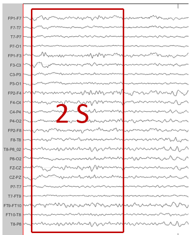 GitHub - linuxciscoarnaud/EpilepticSeizureDetection: Epileptic Seizure Detection using a CNN and ...