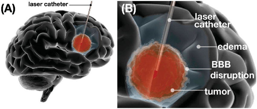 GitHub - Daiyaoxu/Simulation-of-laser-induced-interstitial ...
