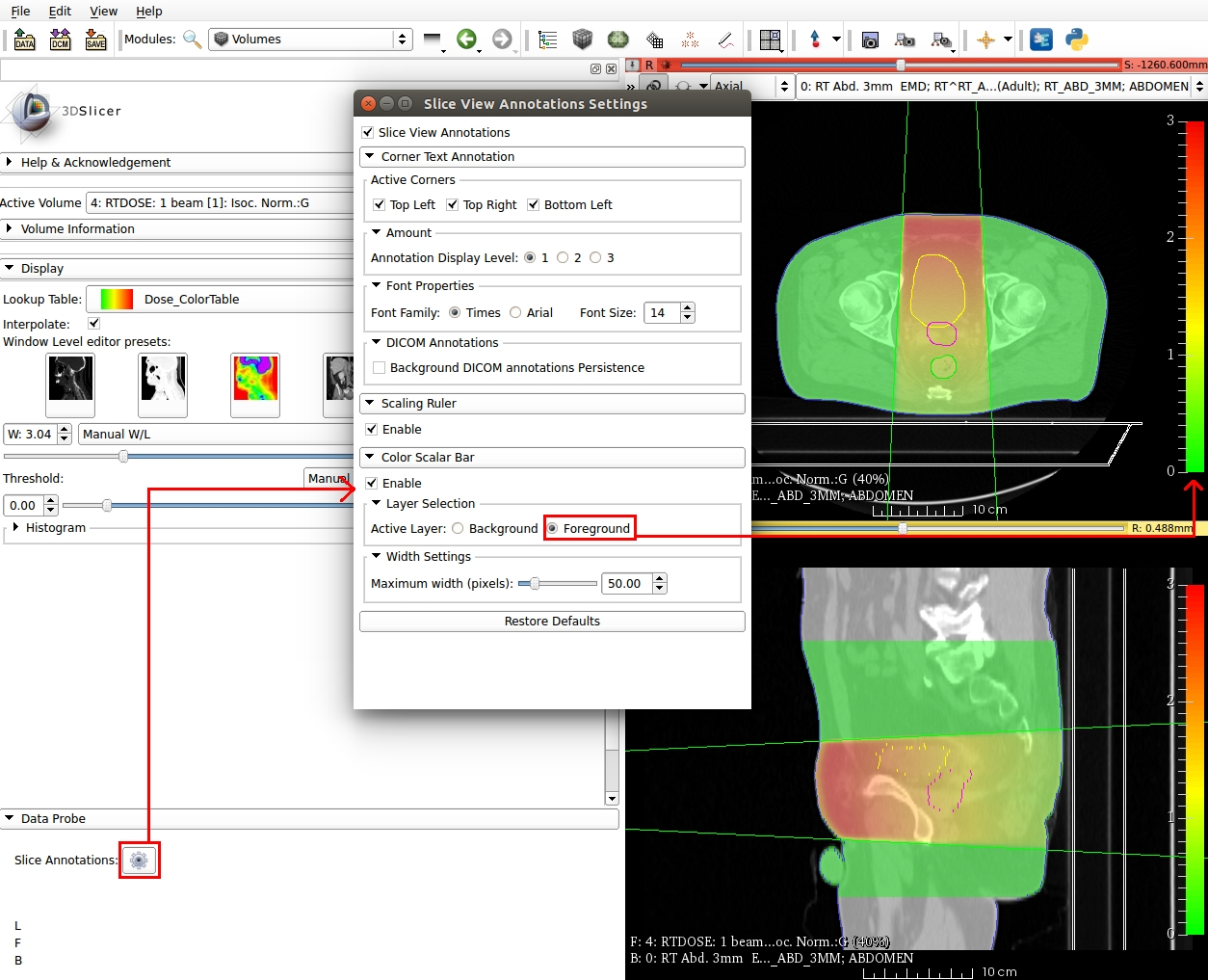 Display dose map colorbar in 2D view · Issue #51 · SlicerRt/SlicerRT ...