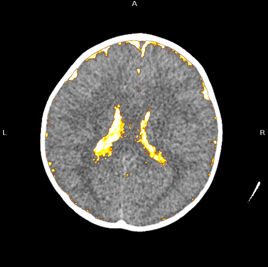 [FEAT EXTRACTION] CSF (Cerebrospinal fluid) used as a ROI for radiomics ...
