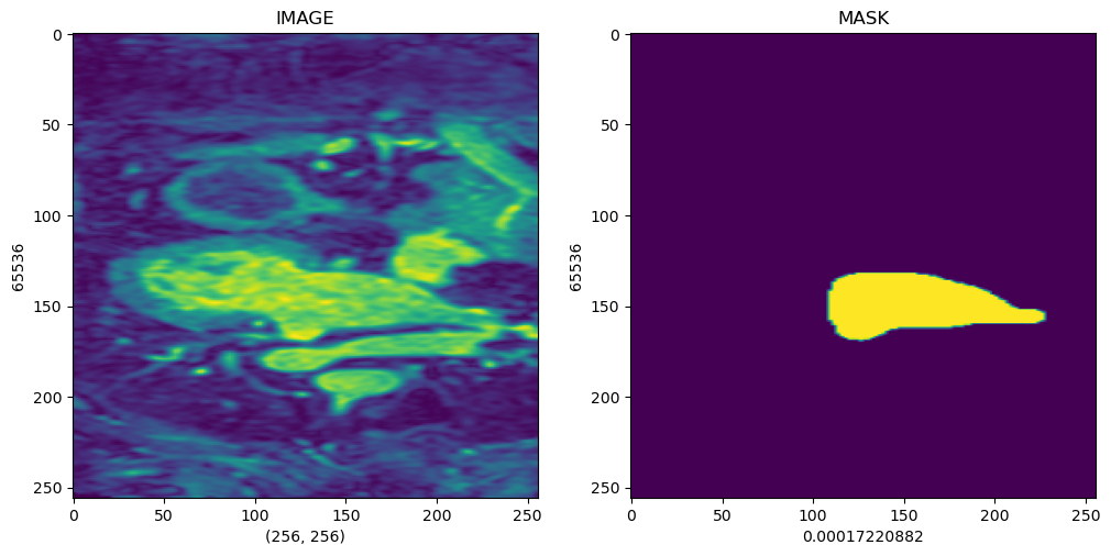 Github Sohelrana Aiub Proheart Mri Image Left Atrial Segmentation Challenge Via Deep Learning 