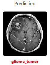 GitHub - IMSoley/PredBrainTumor: A deep learning model for predicting ...