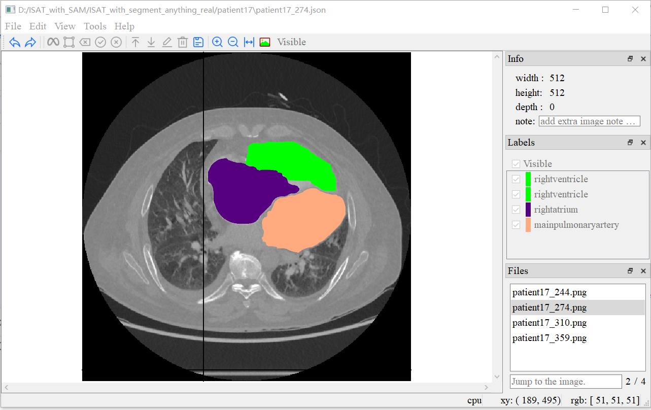 关于医学图像的标注 The medical image annotation issue · Issue #57 · yatengLG/ISAT_with_segment_anything ...